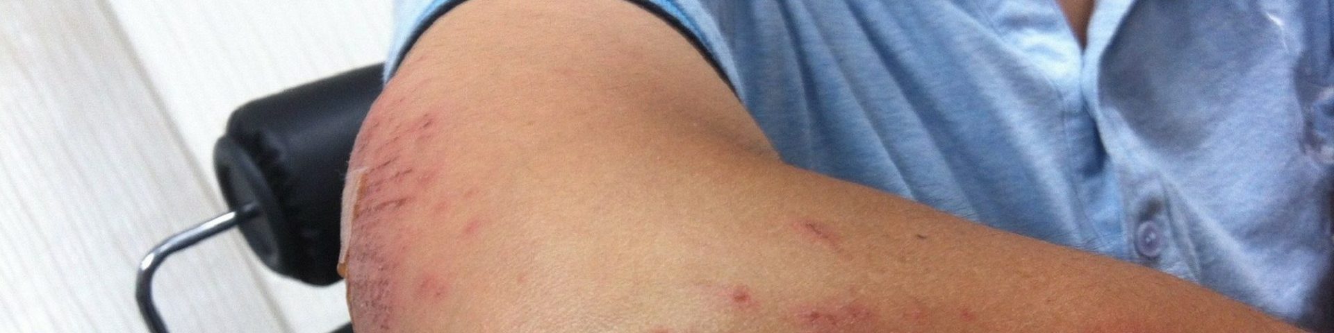 Arbejdsskadeerstatning - Vi hjælper dig igennem processen